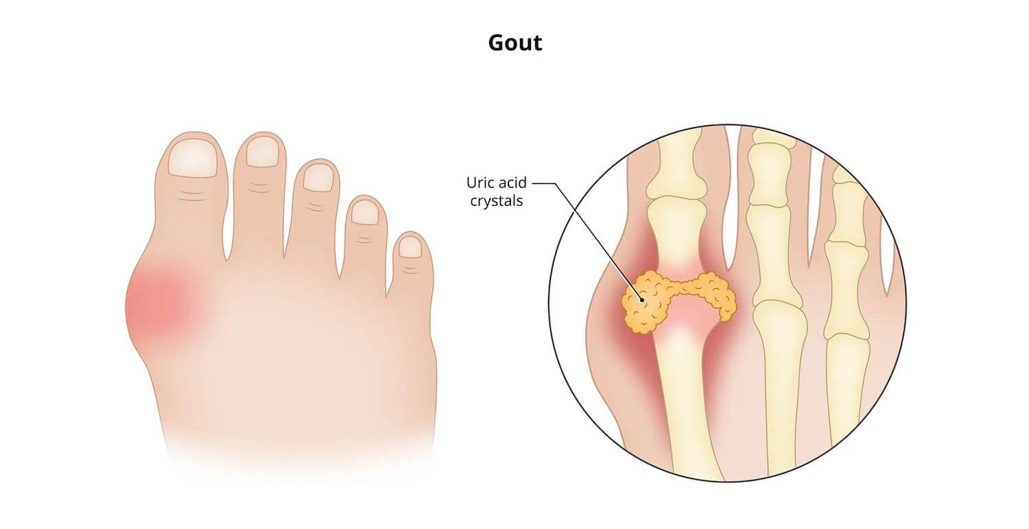 The Causes of Gout Disease and Recognizing Gout Symptoms – Yuri Care